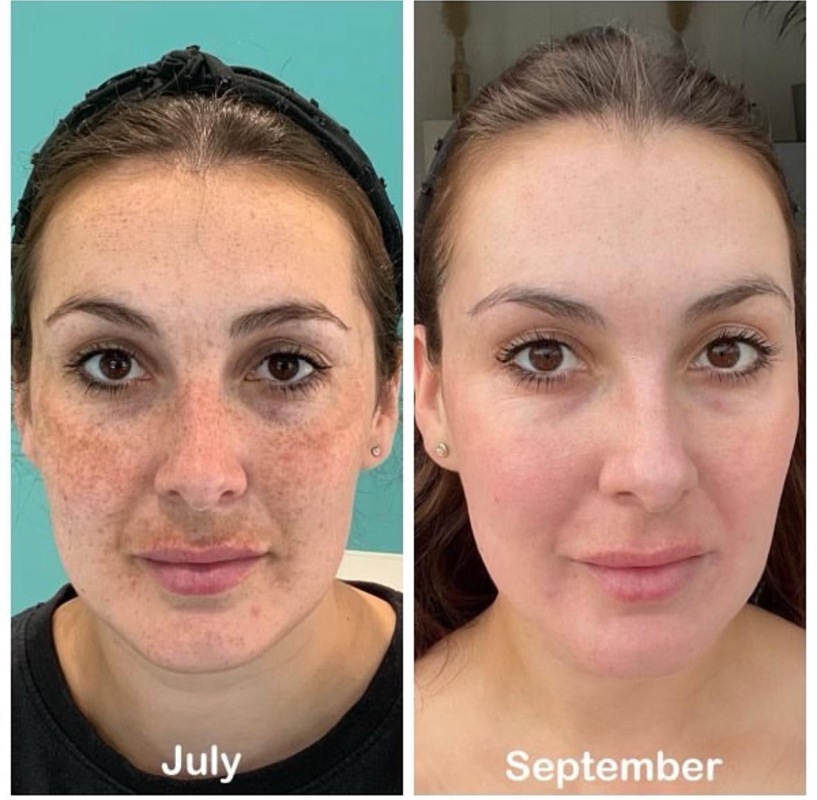 Chemical Peel - SF Aesthetics Wigan