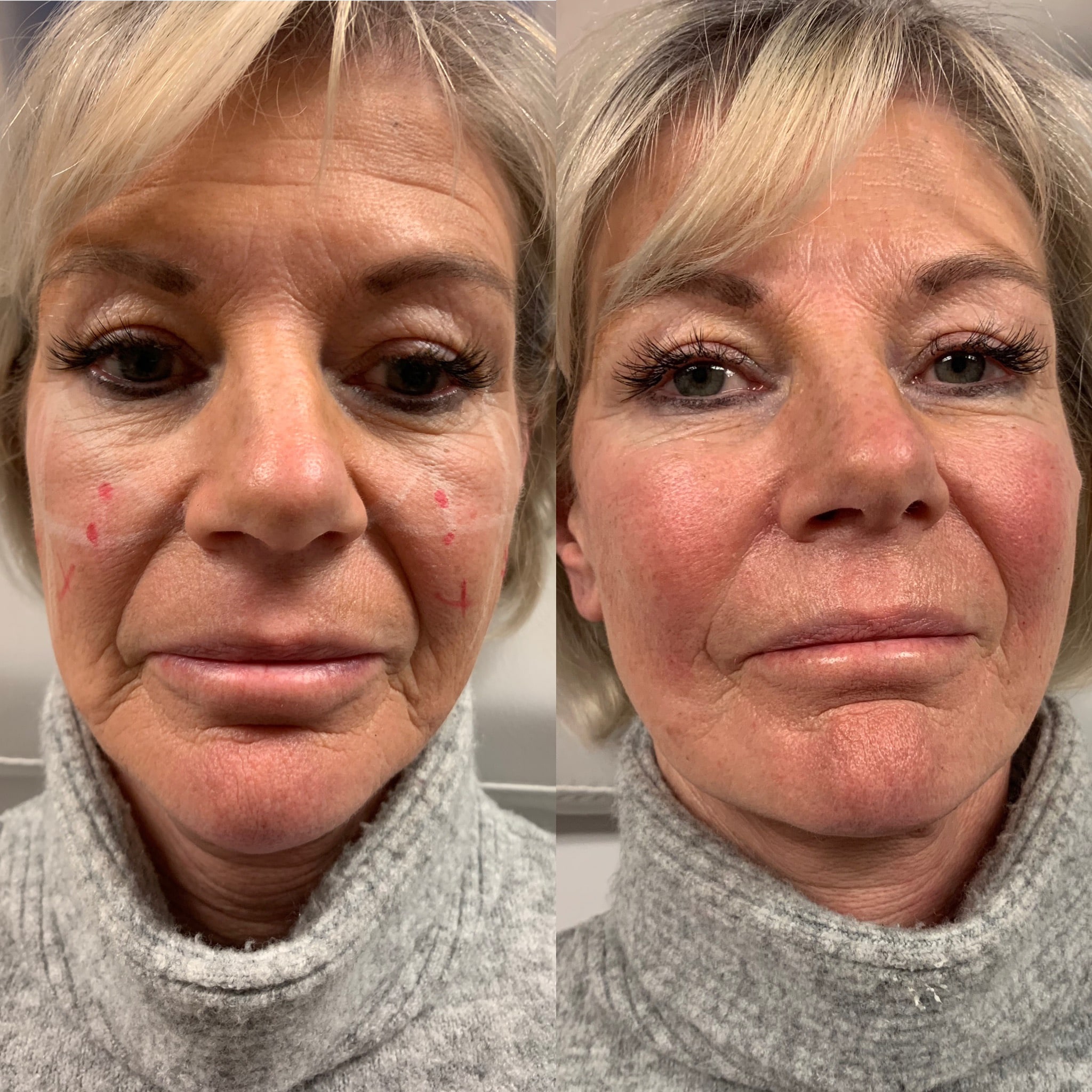 How to Treat Nasolabial Folds with Nasolabial Filler